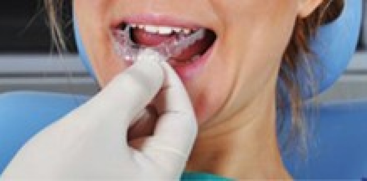 Férulas dentales, tipos de férulas y uso de cada una de ellas ...