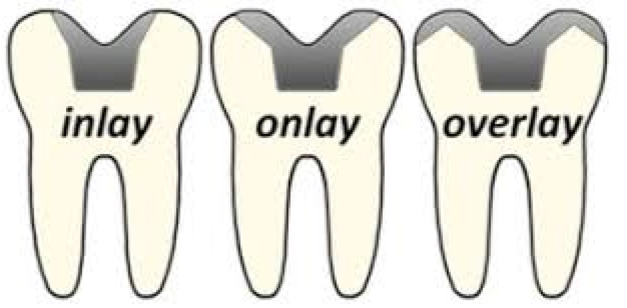 Incrustaciones dentales: inlays, onlays, overlays y adhesión dental ...